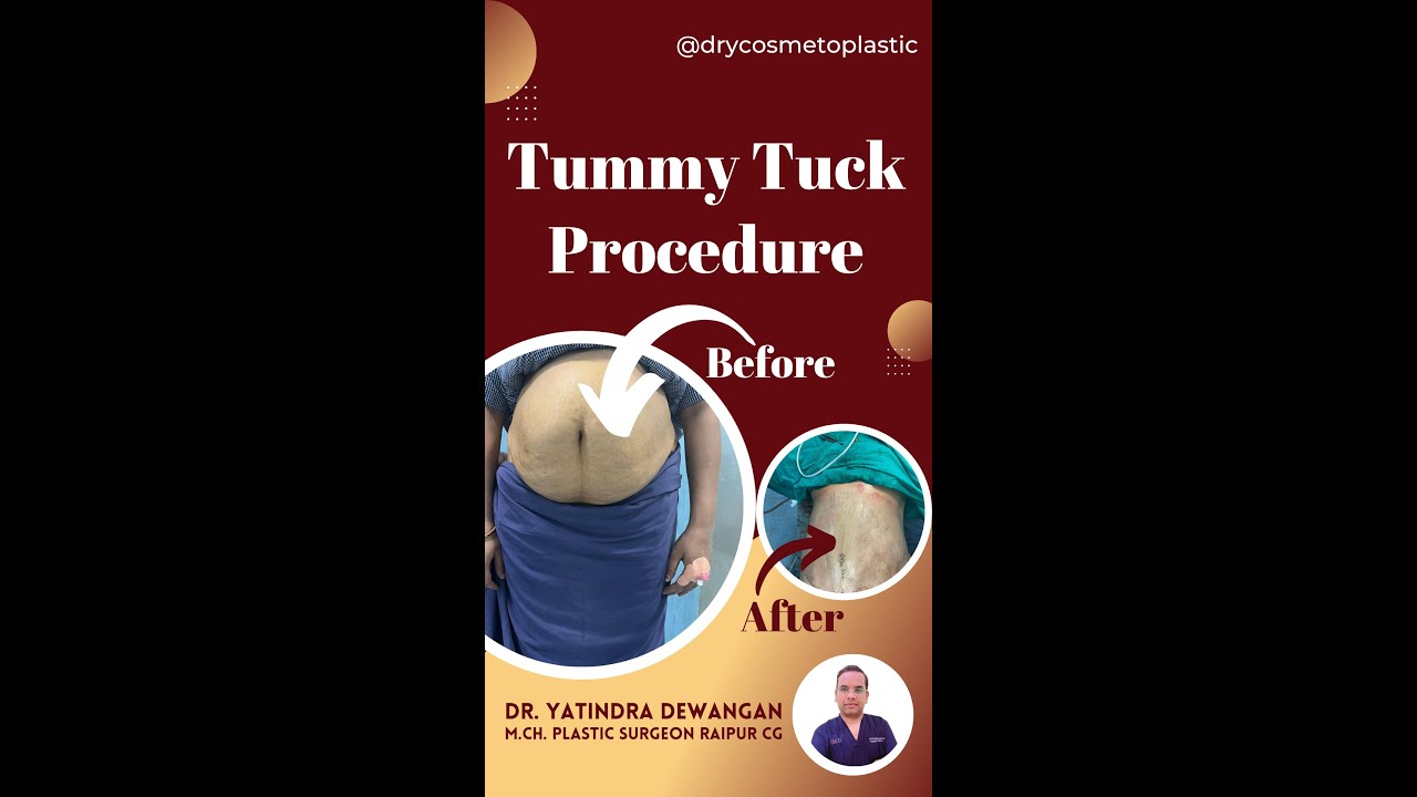 Transform Your Body with Tummy Tuck Procedure | Dr. Yatindra Dewangan ...