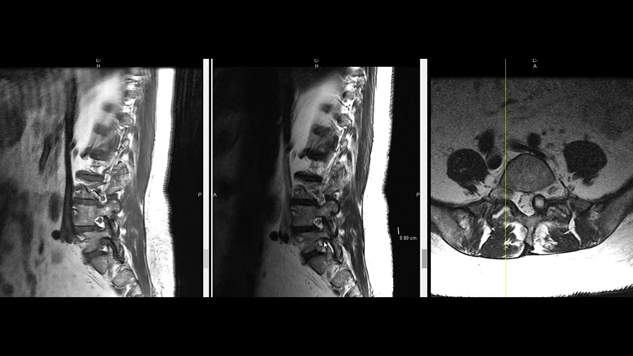 Synovial Cyst Of Lumbar Facet Joint Youtube