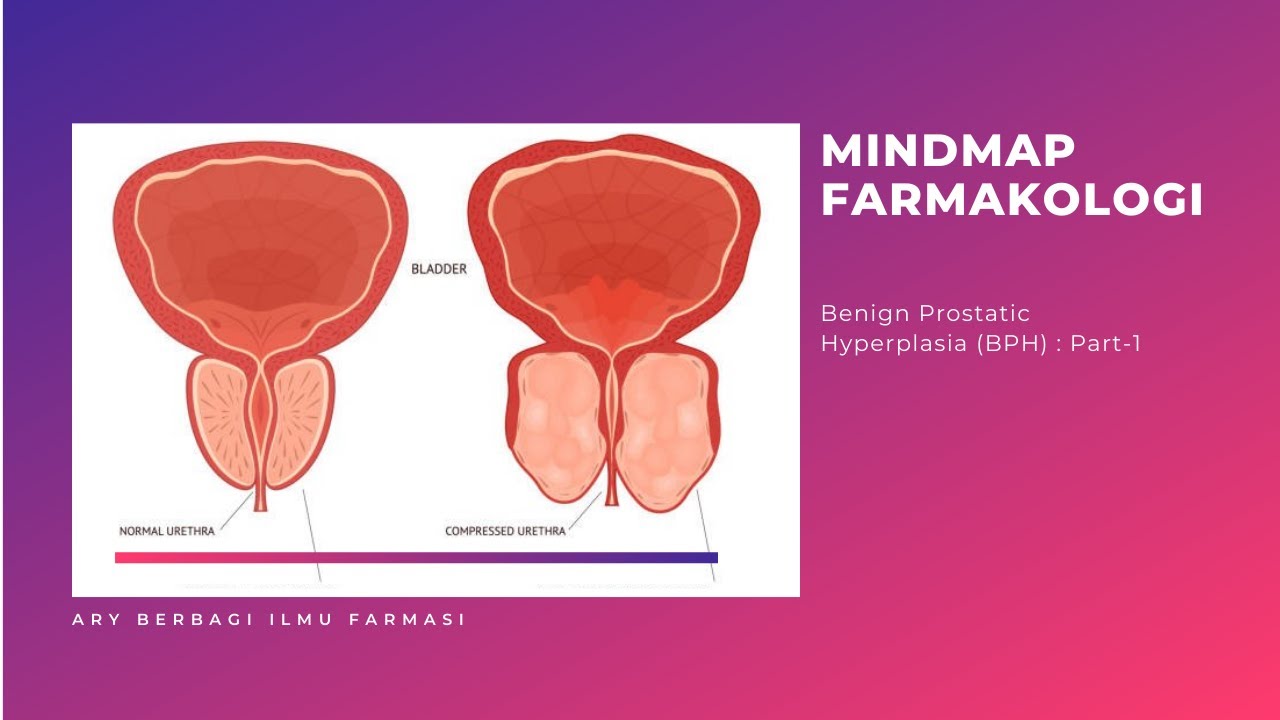 Mindmap Farmakologi Benign Prostatic Hyperplasia (BPH) : Part-1 - YouTube