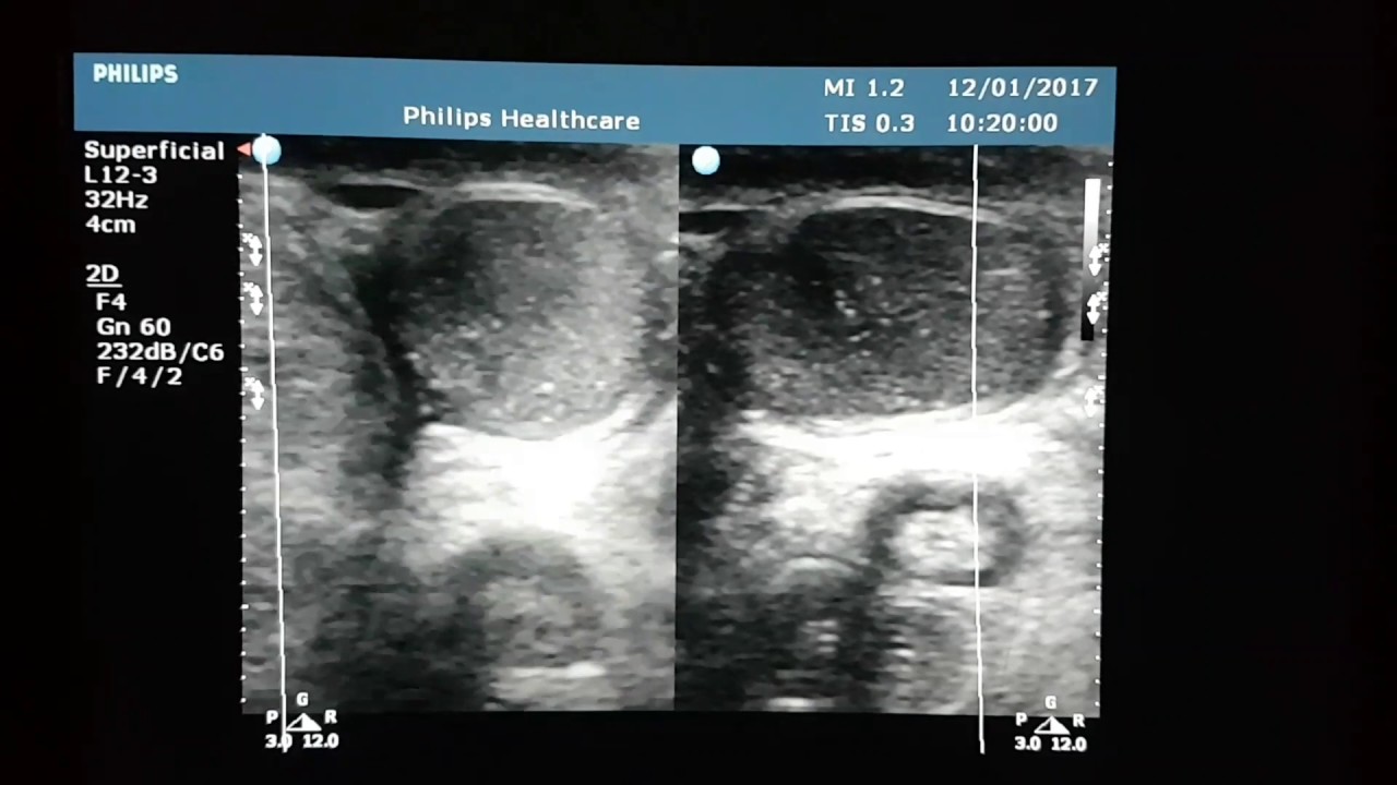 Testicular Microlithiasis Ultrasound Youtube