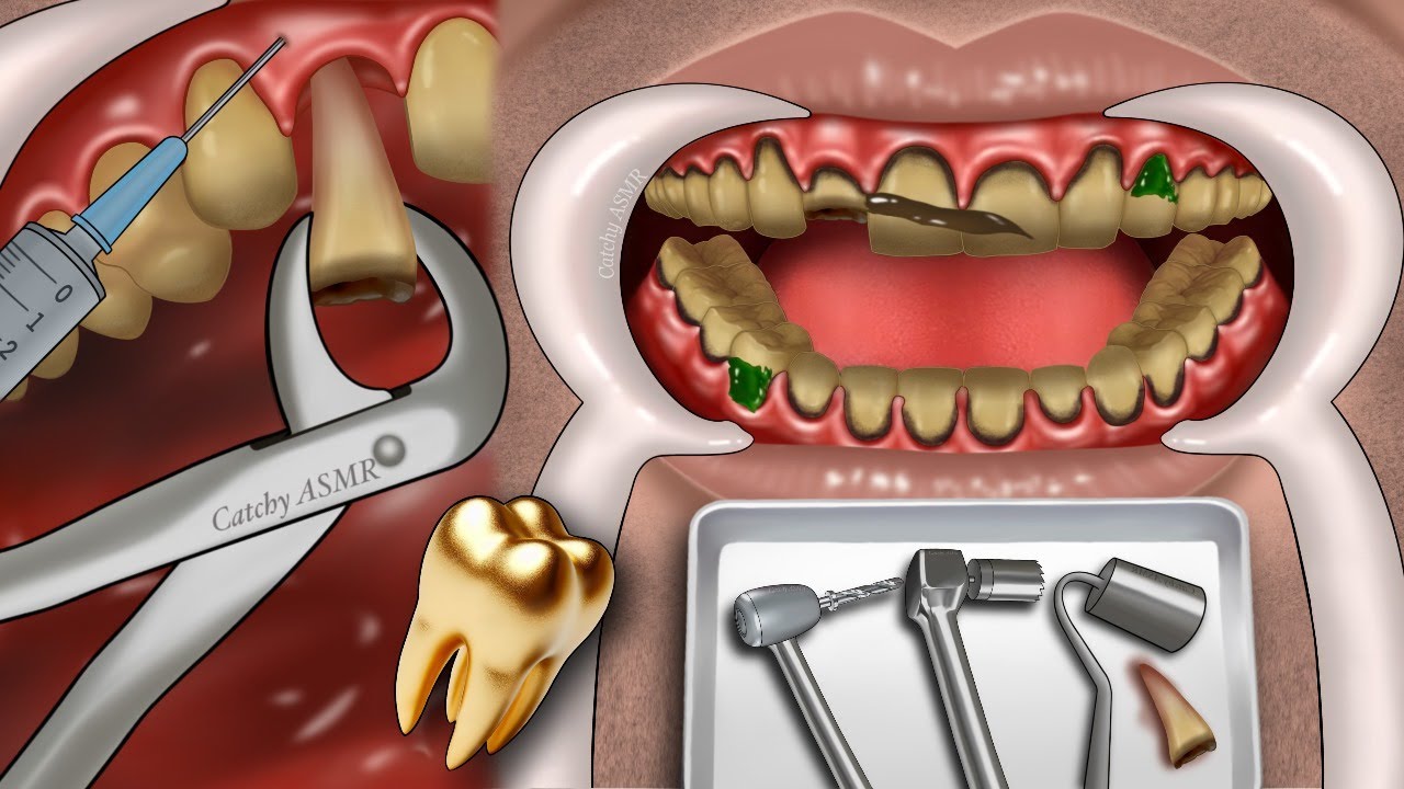 ASMR damage tooth extraction|| gold teeth implant|| dental decay ...