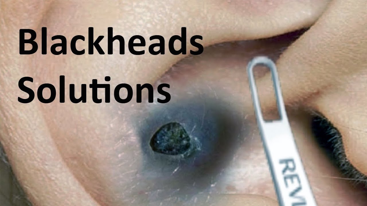 Unmasking Monster Blackheads: Facts and Solutions | Facts About Monster Blackheads in Ear - YouTube