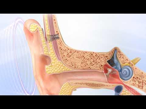 Treatment Bone Anchored: Hearing Aid Animation - YouTube