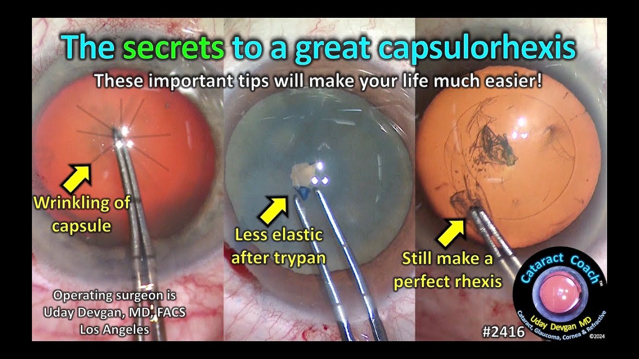 CataractCoach™ 2416: secrets to a great capsulorhexis - YouTube