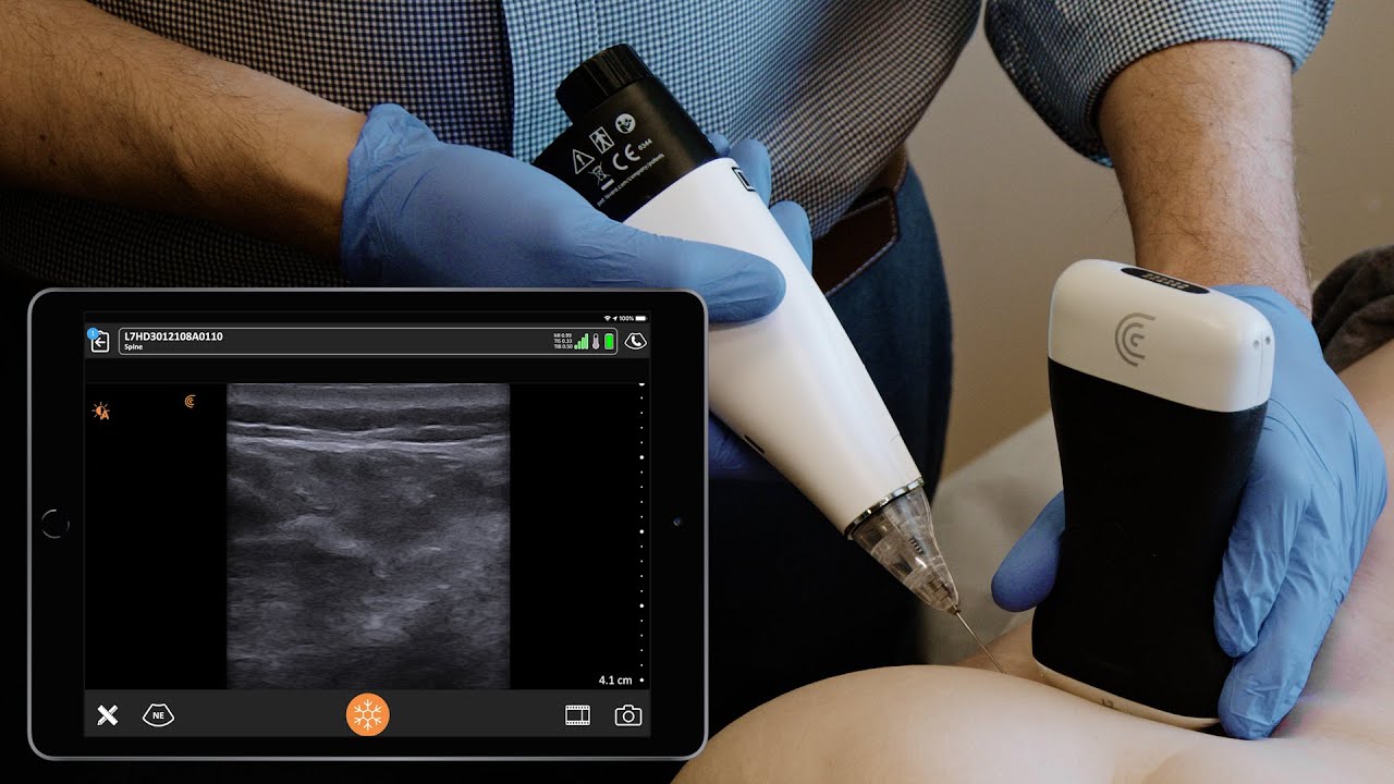 Cluneal Nerve Block - YouTube