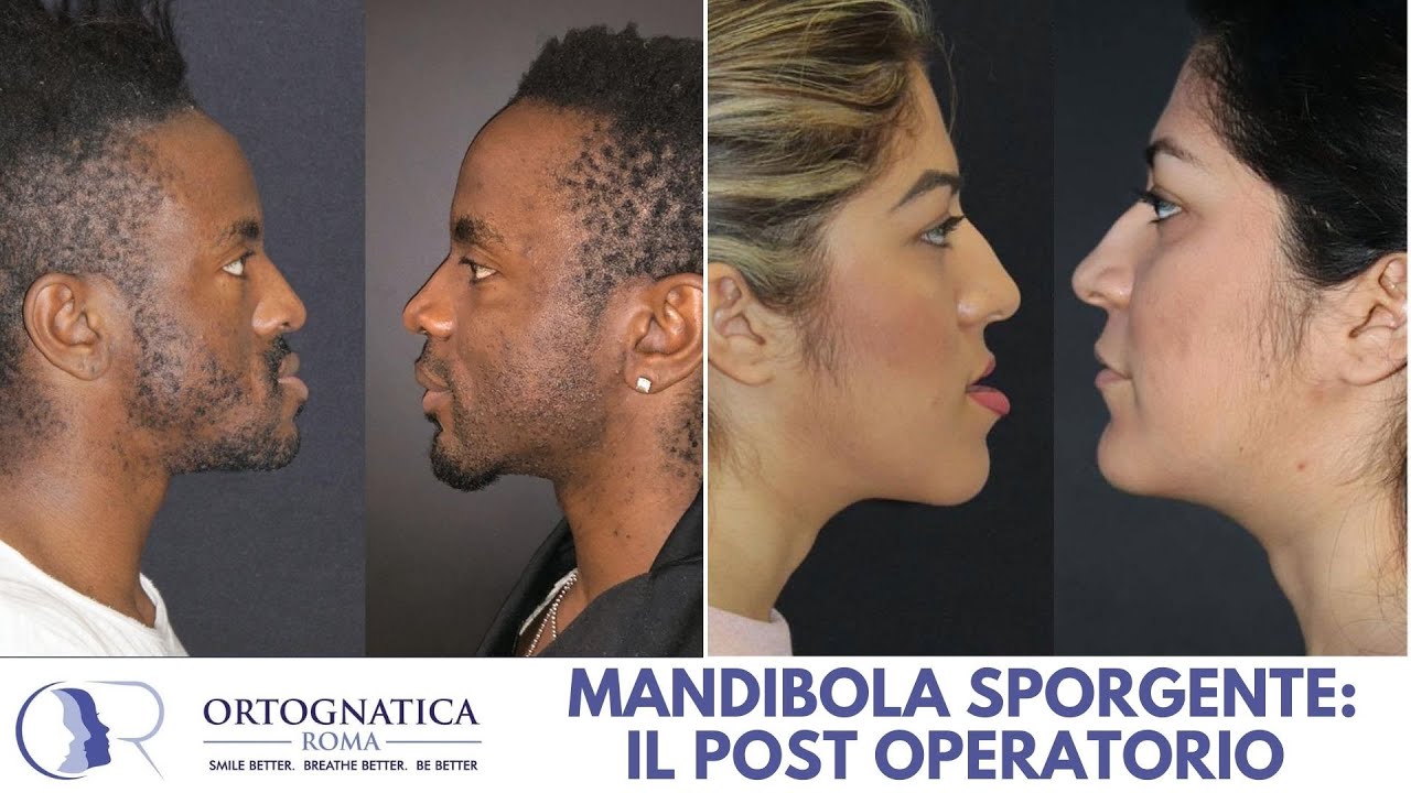 Mandibola sporgente: com'è il post operatorio? - YouTube