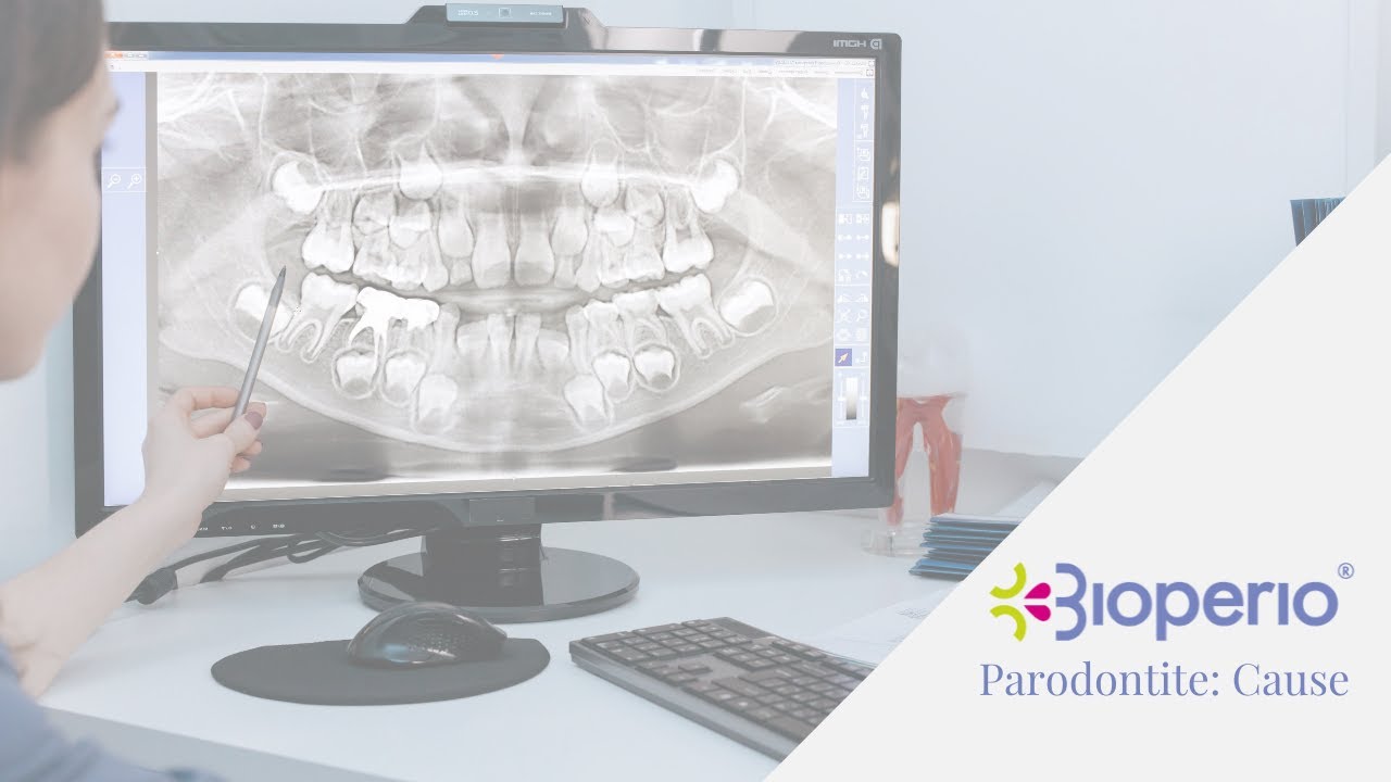Parodontite: Cause - Bioperio ® - YouTube