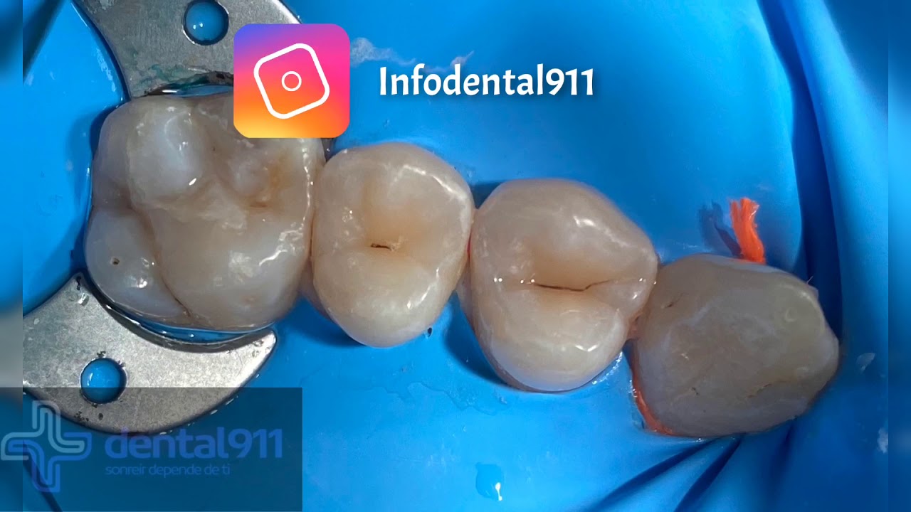 Resinas posteriores (composites )ENA HRI - YouTube