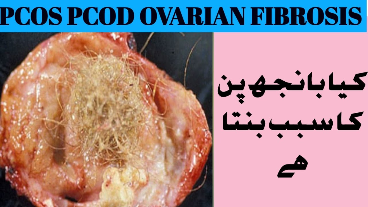 PCOS, Fibroids, Ovarian Cysts & Infertility - YouTube