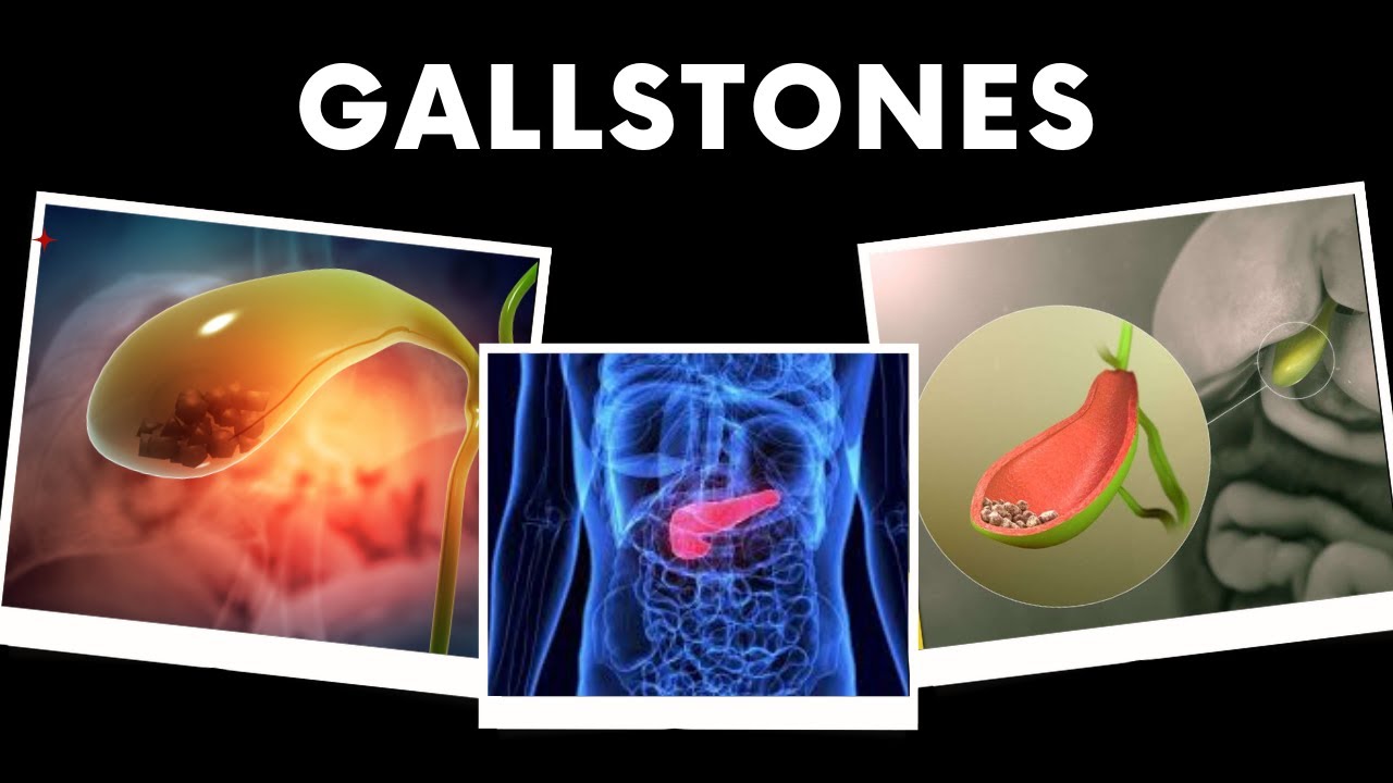 What is Gallbladder || Gallbladder Sign and Symptoms - YouTube