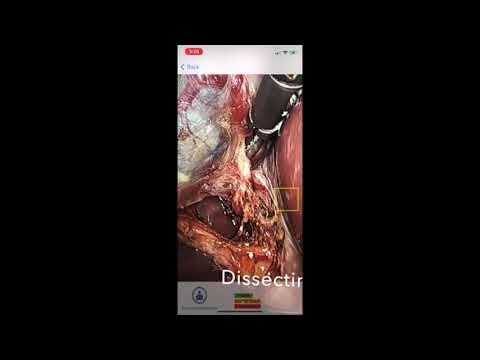 Cholecystectomy AI - Showing JARVIS Touch - YouTube