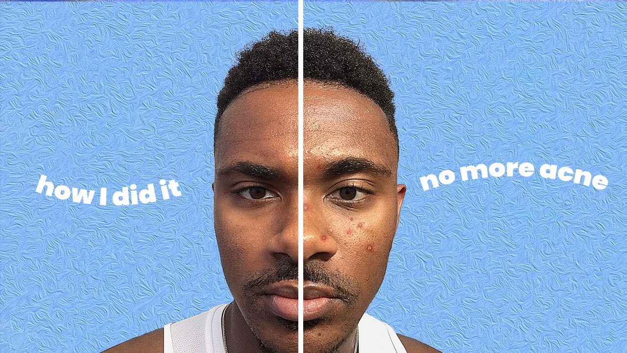 Men's Grooming 101: 6 Reasons Men STILL Get Acne| Men's Skincare Tips ...