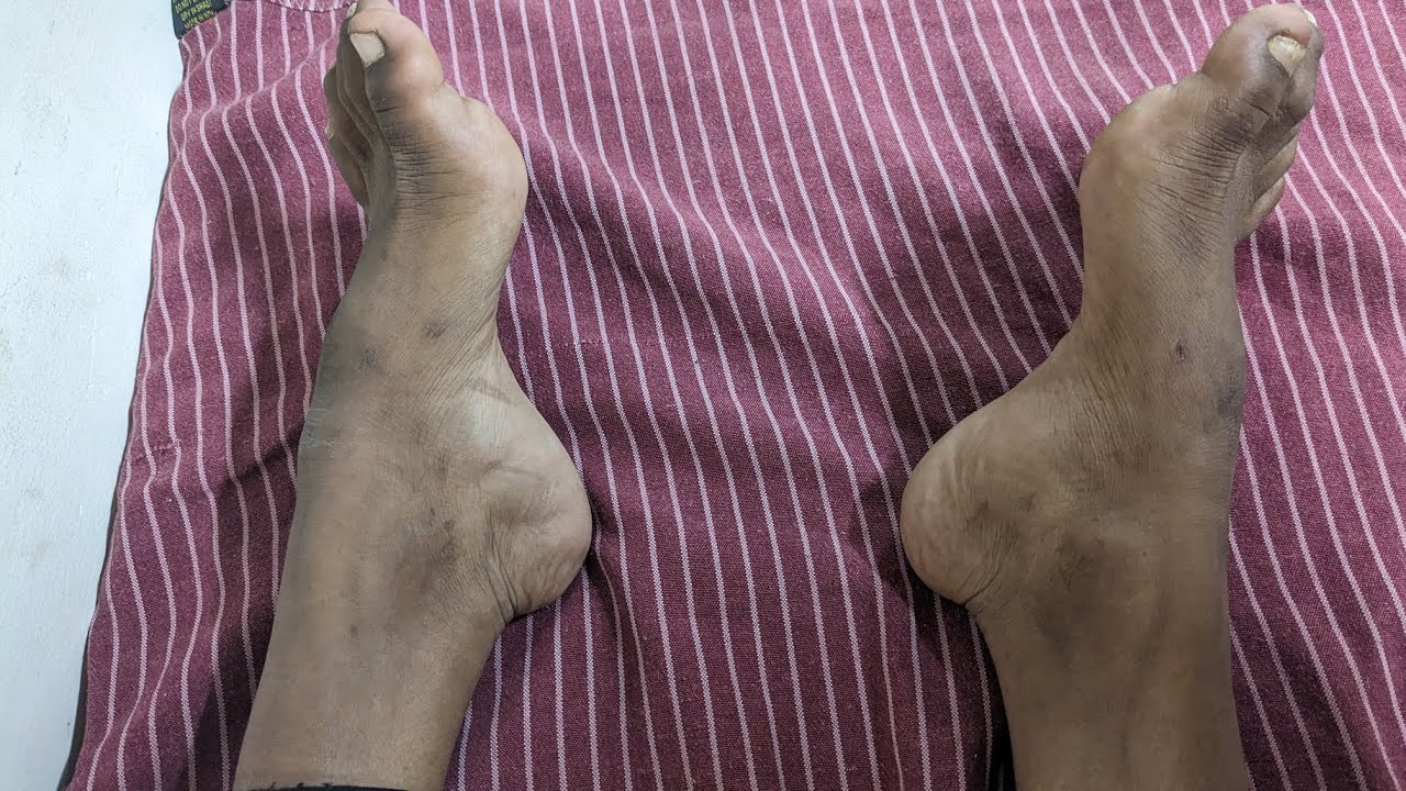 Pes cavus and equinovarus deformities in Neurology! @Dr.KamaleshTN ...