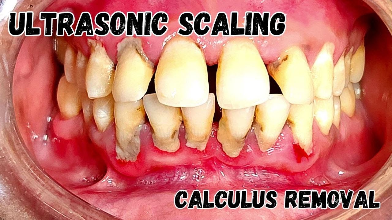 Teeth cleaning | Satisfying Calculus removal | gingivitis treatment ...