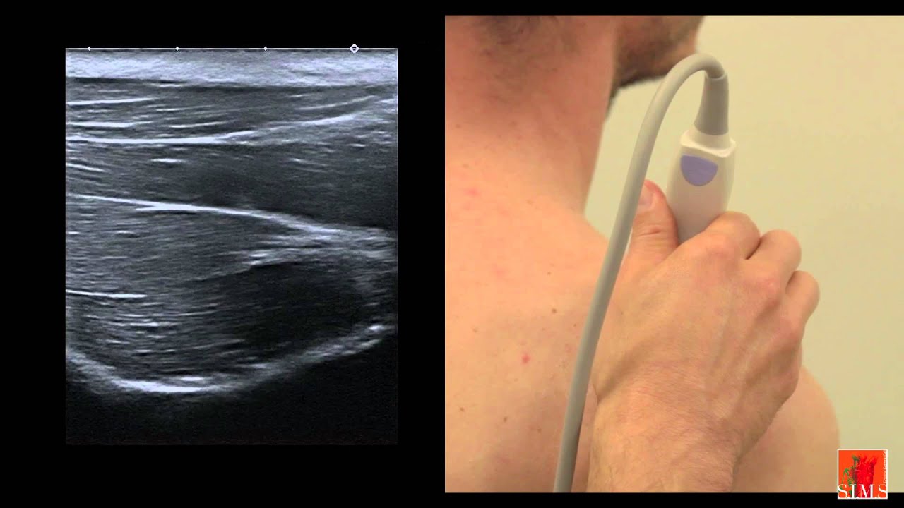 ultrasound of the shoulder III - YouTube