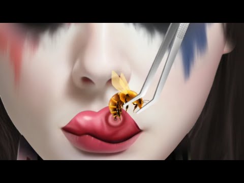 Treatment of huge swollen wasp sting wound | ASMR treatment video ...