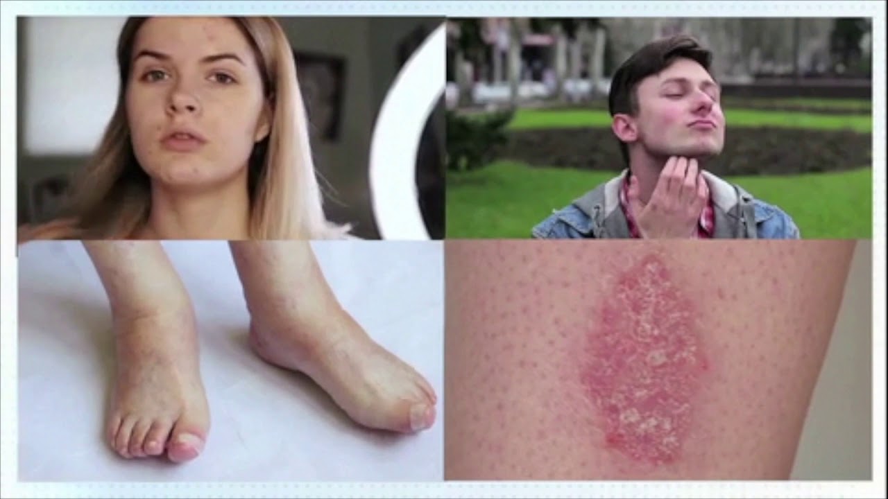 ANTILERGY BENGALI VERSION BY ELEMENTS WELLNESS - YouTube