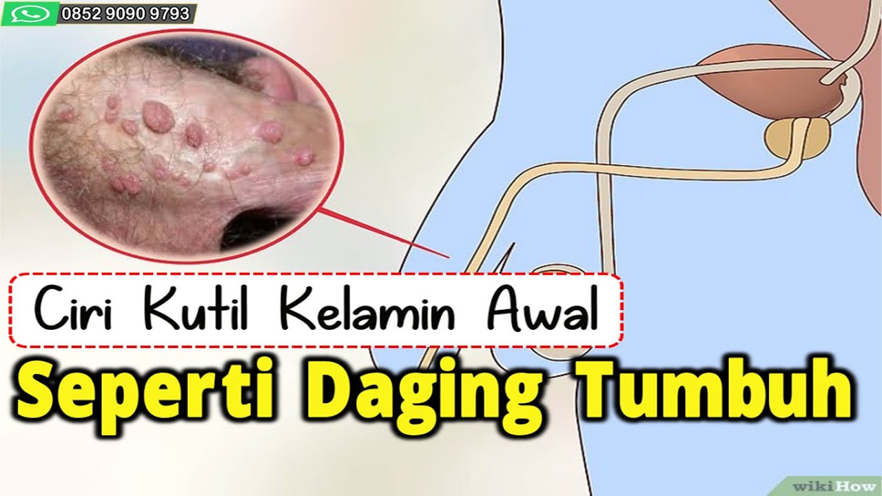 Ciri Kutil Kelamin Awal Seperti Daging Tumbuh - YouTube