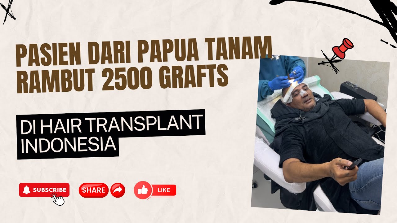 Tanam Rambut 2500 Grafts Bagian Depan, Terbaik! - YouTube