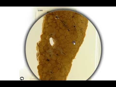 Liver cirrhosis gross - YouTube