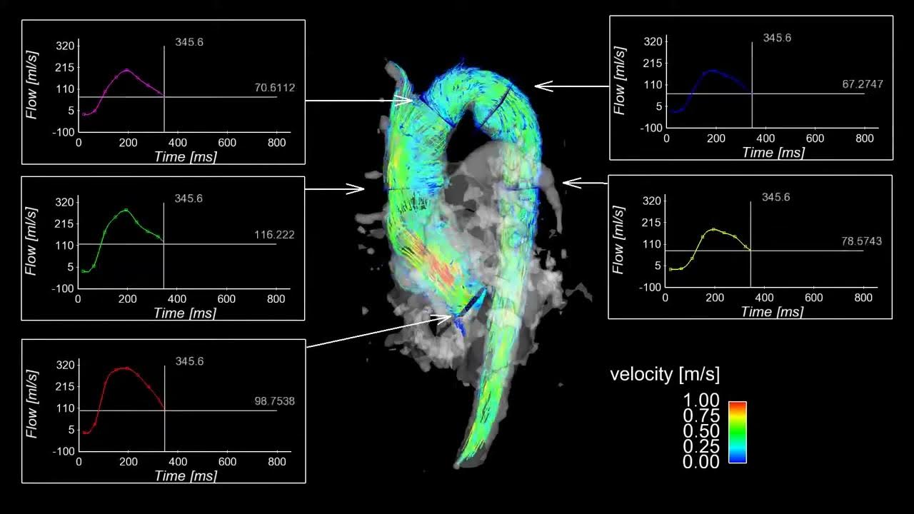 Aortic 4D flow MRI 3D blood flow visualization & flow quantification in aortic valve ...