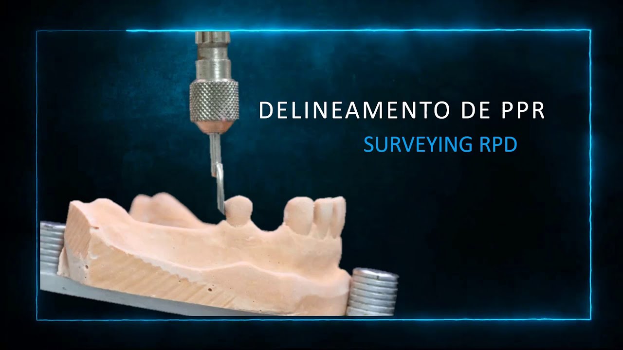 Delineamento de PPR - Surveying RPD - YouTube