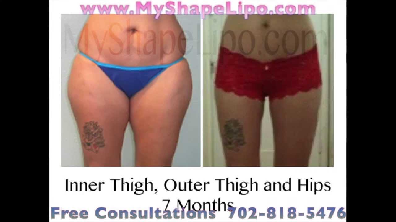 Thighs Liposuction, Inner Thigh, Outer Thigh, Full Thigh; Before and After, MyShape Lipo - YouTube