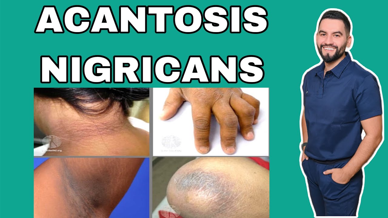 ACANTOSIS NIGRICANS / ACANTOSIS PIGMENTARIA / TENGO EL CUELLO Y LAS ...