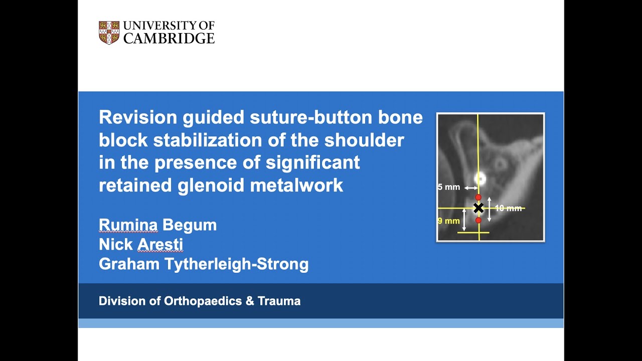 Revision bone block stabilisation using a guided suture-button ...