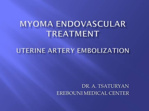 Embolization of UA - three patients case presentation - YouTube
