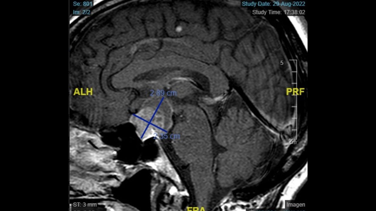 Craneofaringioma supraselar. Abordaje endoscópico transtuberculum - YouTube