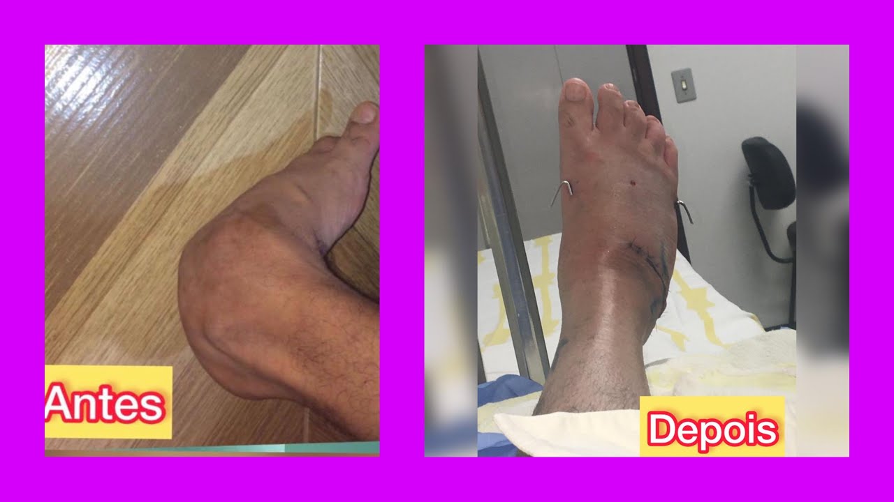 PÉ TORTO ADULTO CONGÊNITO TEM TRATAMENTO SIM - YouTube