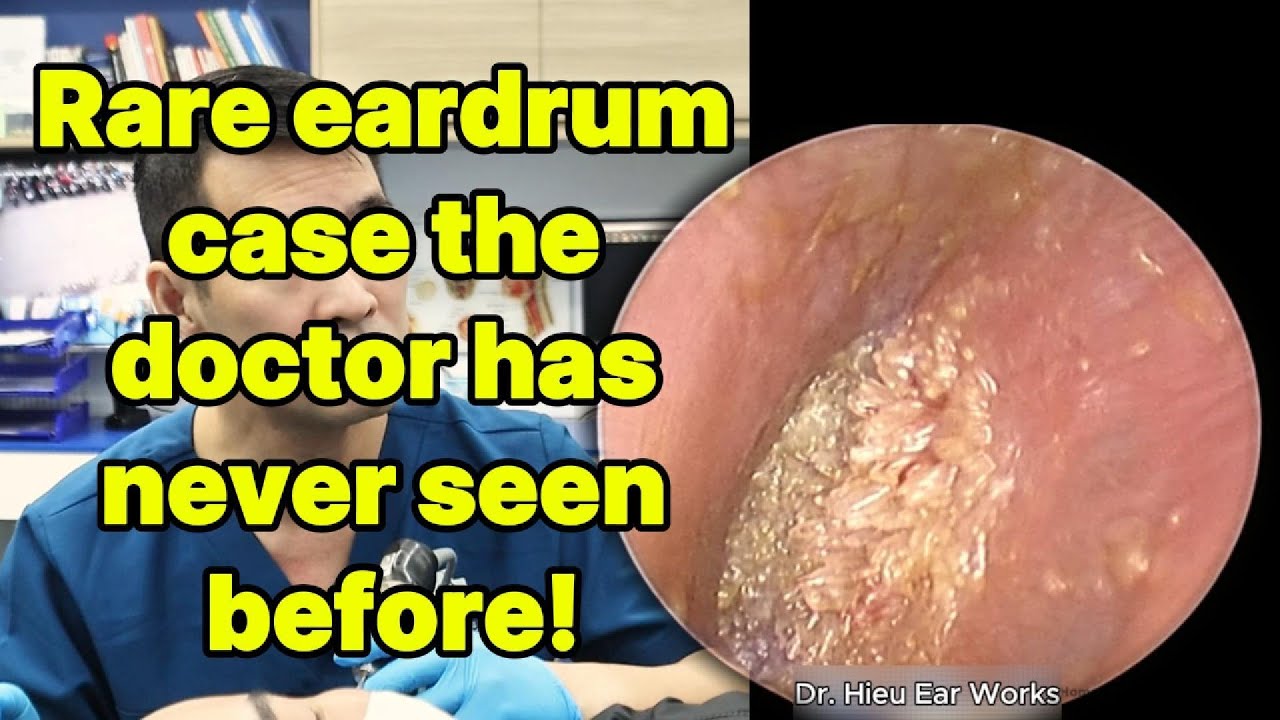 Rare eardrum case the doctor has never seen before | ear cleaning ...