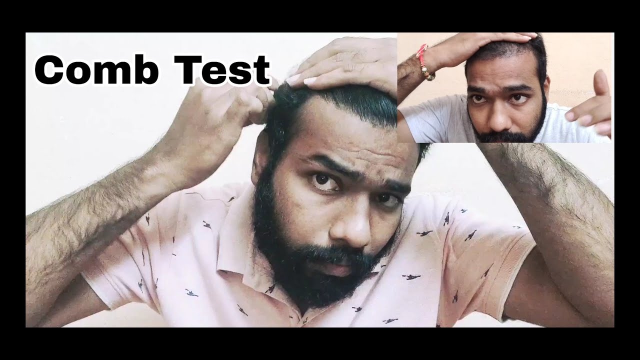 Comb Test After Hair transplant Result - YouTube