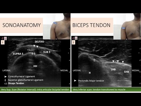 ULTRASOUND OF SHOULDER (PART1)/SCANNING NORMAL SHOULDER/US GUIDED ...