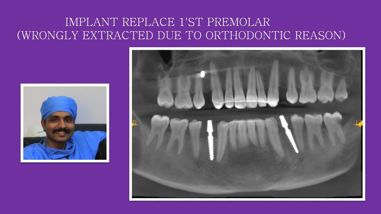 IMPLANT REPLACE 1'ST PREMOLAR (WRONGLY EXTRACTED DUE TO ORTHODONTIC ...