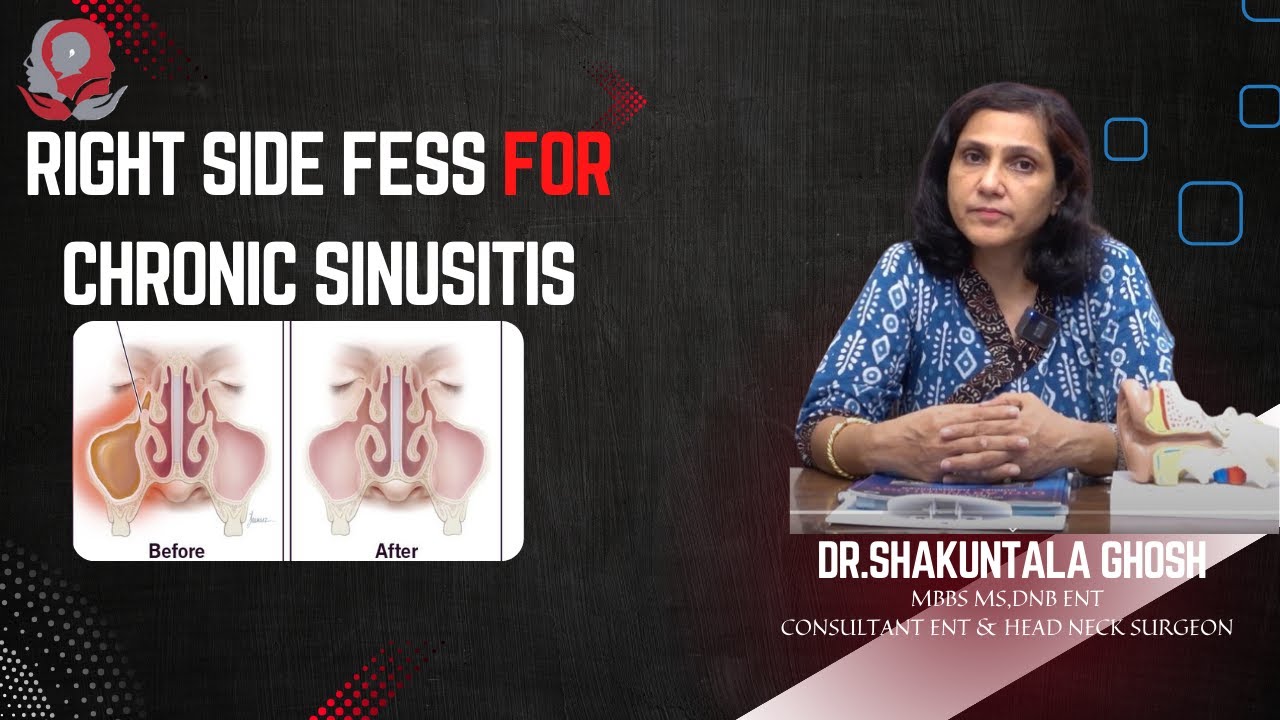Right Side Fess For Chronic Sinusitis | DR.Shakuntala Ghosh | ENT | Sri ...