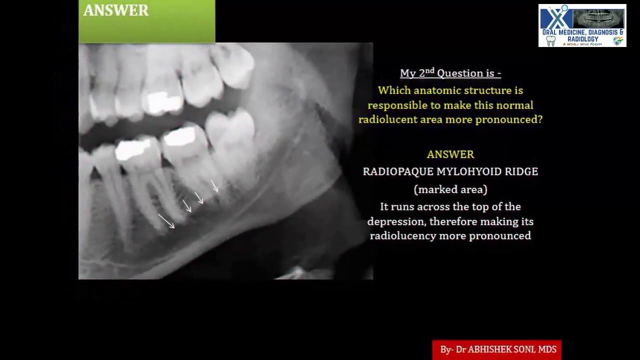 ANATOMIC RADIOLUCENCIES OF JAWS - YouTube