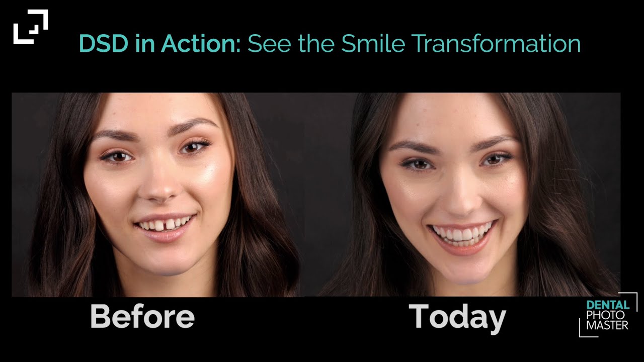 DSD in Action: See the Smile Transformation - YouTube