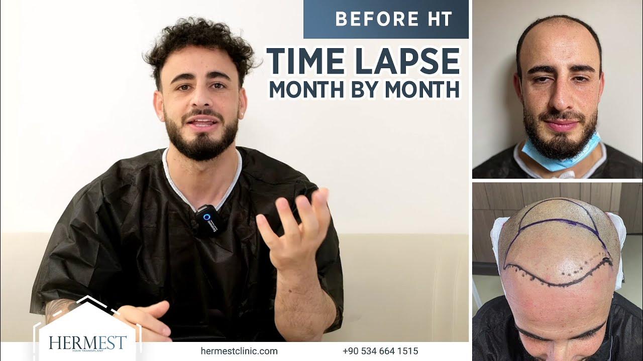 Fue Hair Transplant Time Lapse Result In Turkey Before And After
