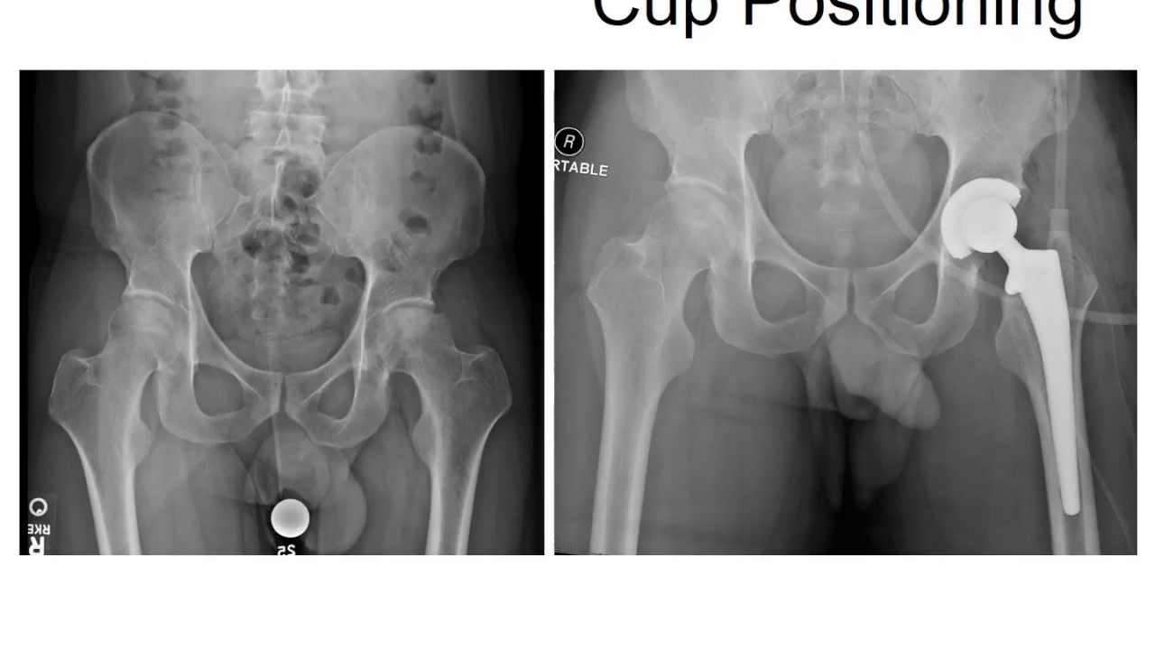 Cup Positioning and Anatomic Restoration: Using Fluoroscopy in the ...