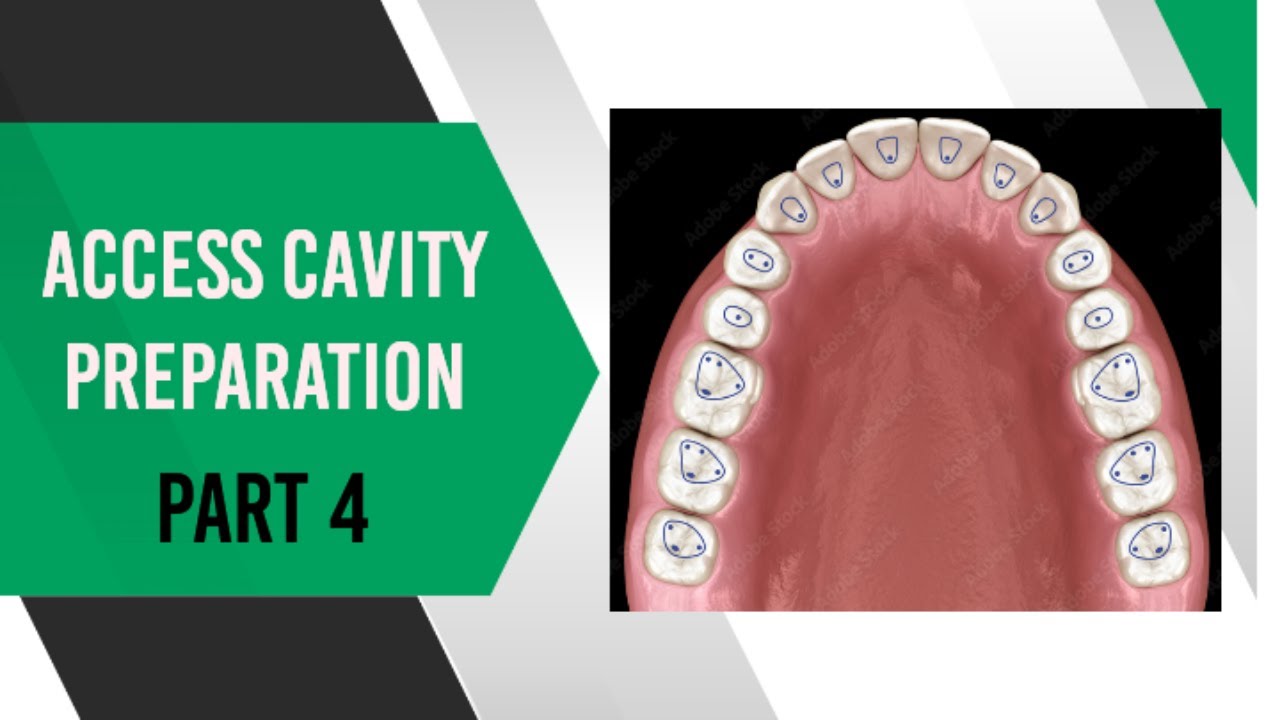 ACCESS CAVITY PREPARATION PART 4 (TOOTH MORPHOLOGY & NUMBER OF POSSIBLE ...