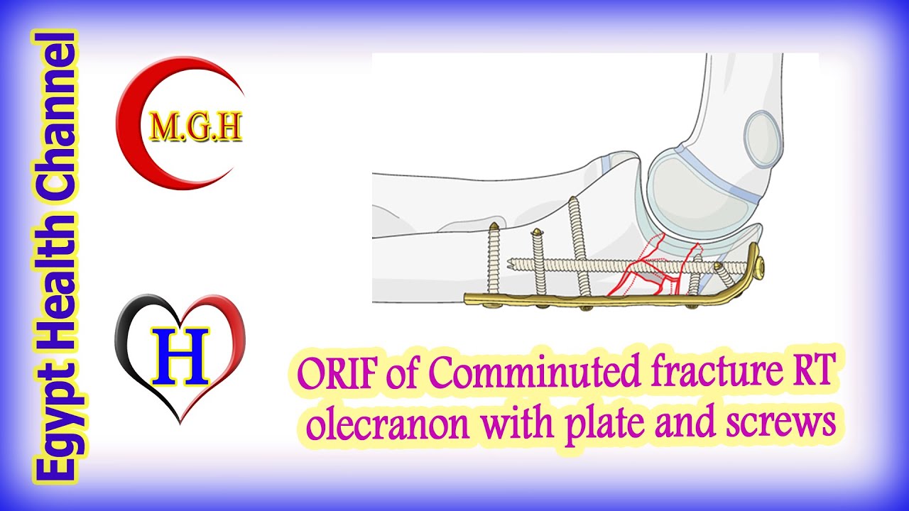ORIF of Comminuted fracture RT olecranon with plate and screws - YouTube