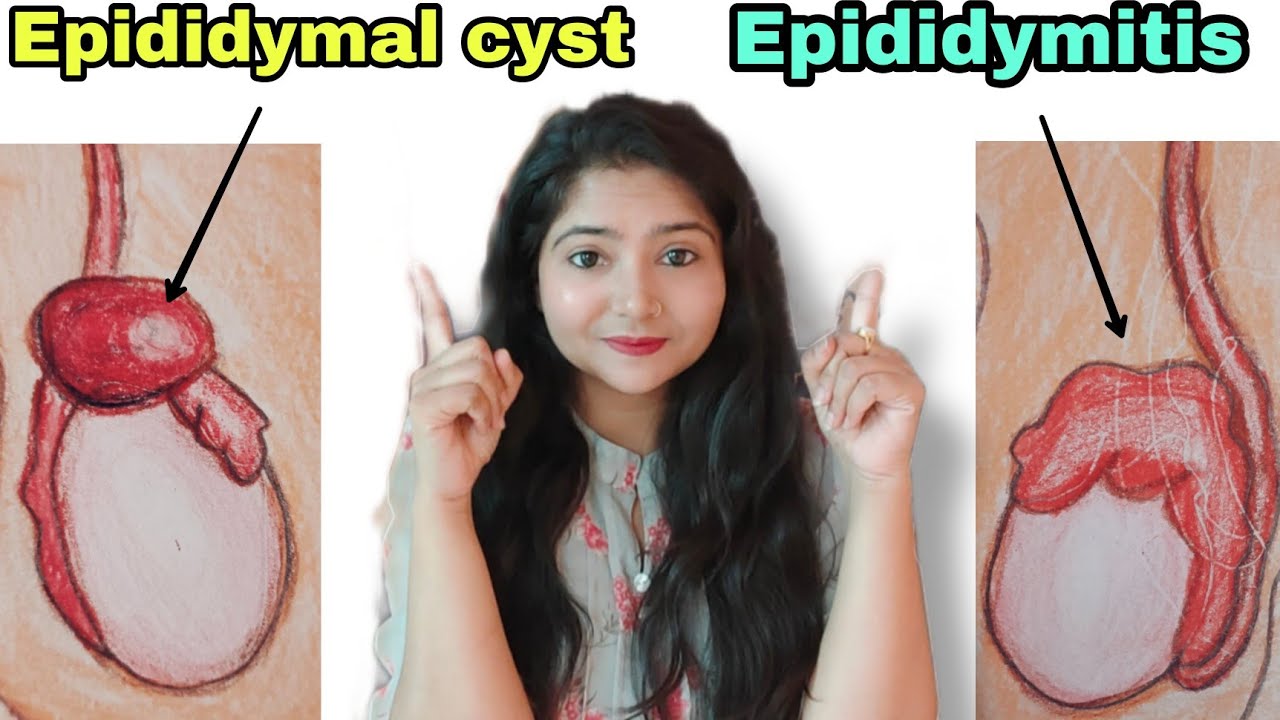 Epididymal Cyst Epididymitis Treatment Scrotal Pain YouTube Epididymal Cyst Epididymitis Treatment Scrotal Pain YouTube