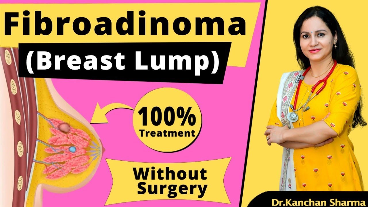 Fibroadenoma Breast | Lump In Breast | Fibroadenoma Breast Natural ...