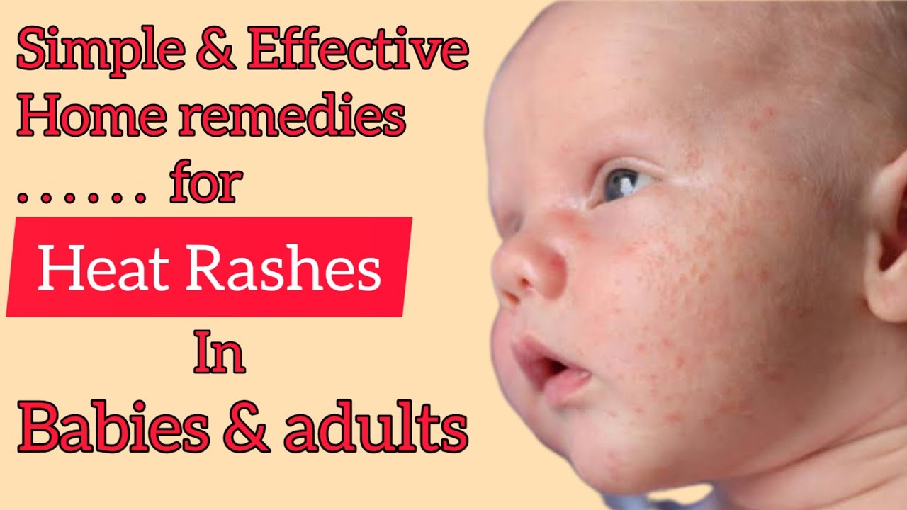 How to treat Heat Rashes in babies| Bachon main garmi dano ko ghr pe ...