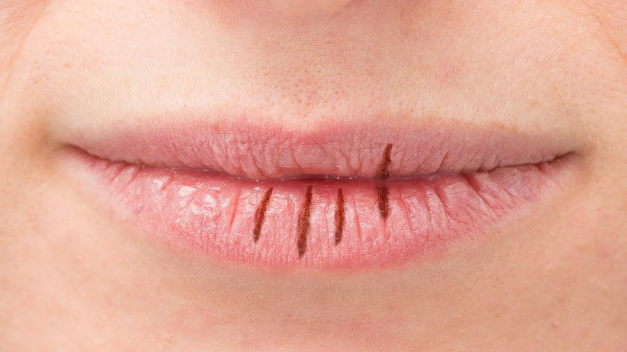 CAUSES OF DRY OR CRACKED LIPS IN TCM - YouTube