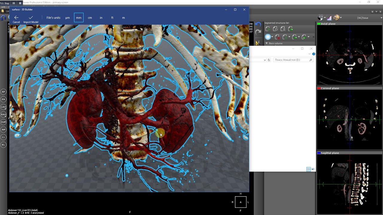 Exporting The Surface Of A 3D Model Using Inobitec DICOM Viewer Pro exporting-the-surface-of-a-3d-model-using-inobitec-dicom-viewer-pro