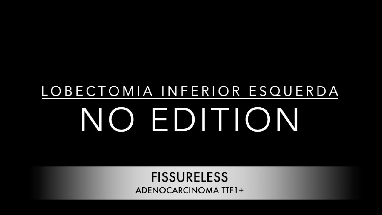 Left Lower Lobectomy FISSURELES NO EDITION YouTube left-lower-lobectomy-fissureles-no-edition-youtube