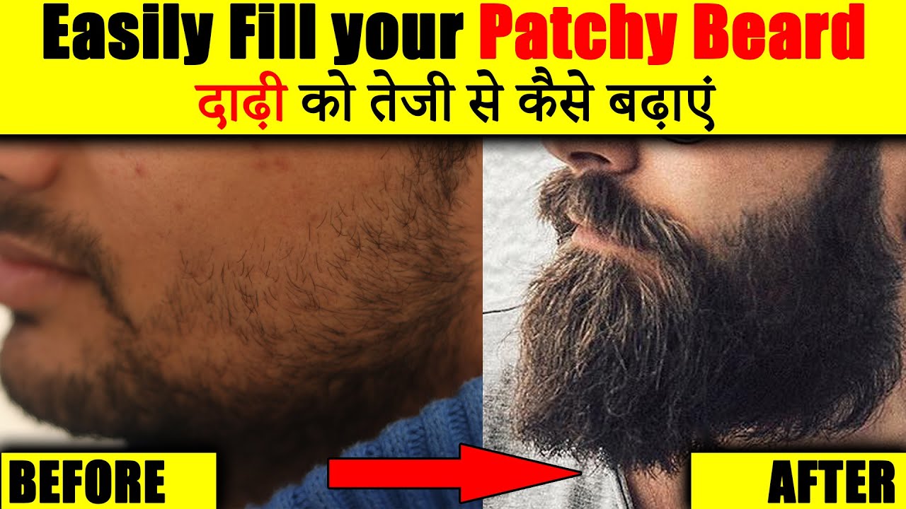 How to fill patchy Beard in HINDI 2020 | दाढ़ी को तेजी से कैसे बढ़ाएं ...